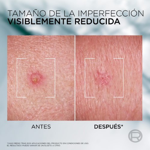 Derma Control Cuidado Facial S.O.S Pimple Paste Solución Anti ...